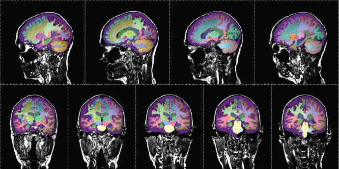 Brainreader | FDA-Cleared Brain Volumetric MRI Software for Neurodegen